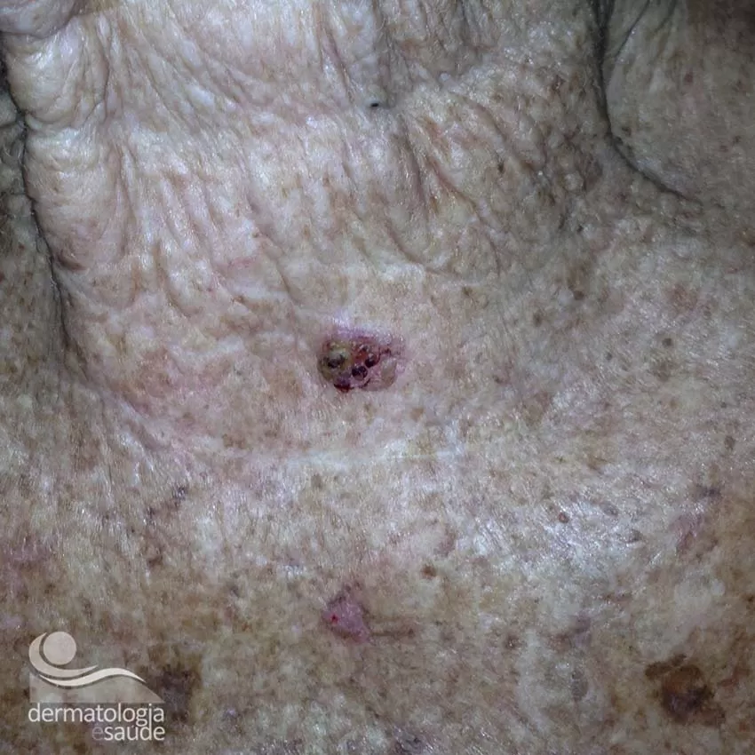 Doença de Bowen - Doenças de Pele